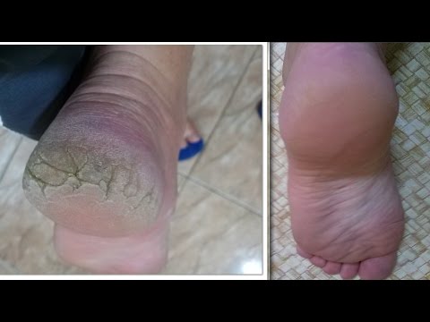 Como se livrar do calcanhar rachado com receitas caseiras