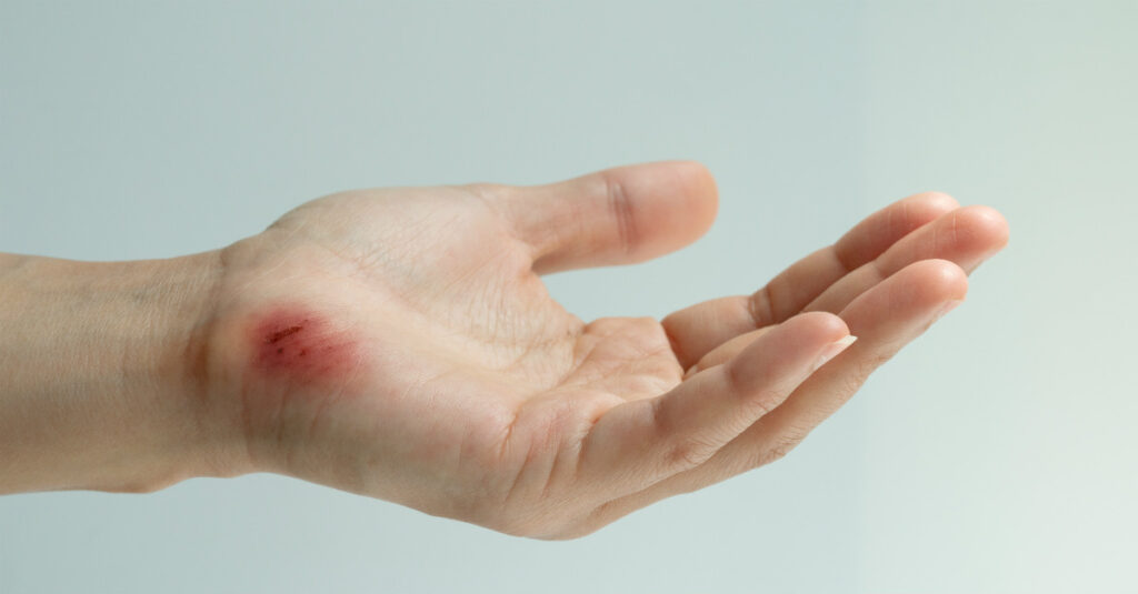 Água oxigenada para machucado é bom? E o que fazer quando se ferir