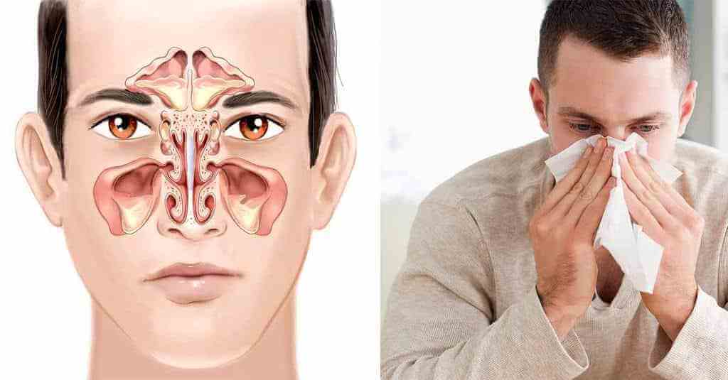 Tratamento eficaz para a rinite!