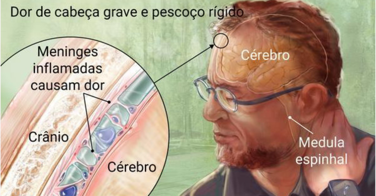 Meningite bacteriana: sintomas, transmissão e prevenção