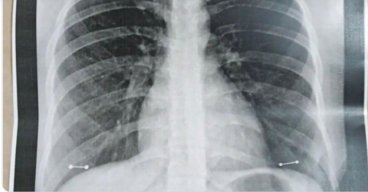 Exame raio-x revela segredo de jovem para a família: piercings nos seios