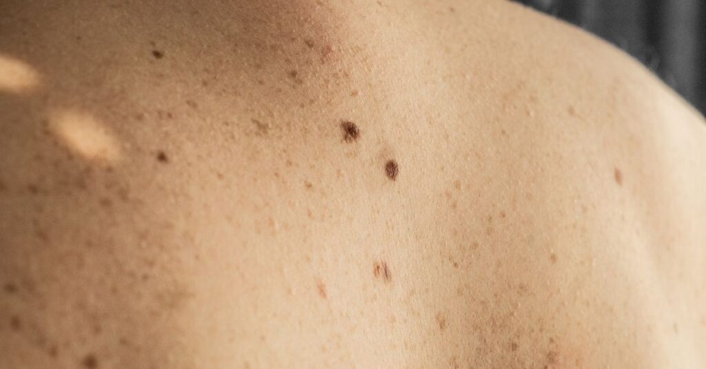 Melanose solar: saiba o que é, como prevenir e como tratar