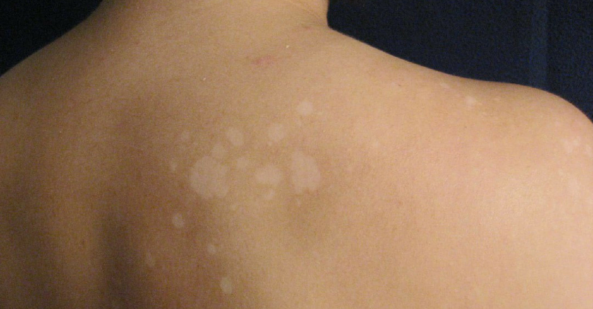 Pano branco: o que é, causas e tratamento desse problema de pele