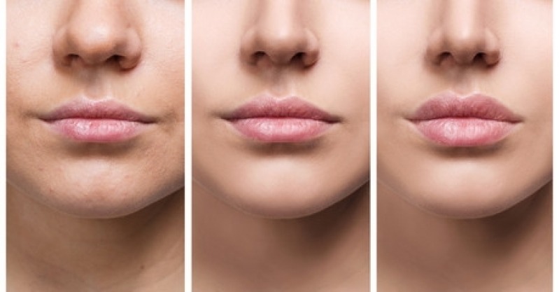 Como funciona preenchimento labial: tipos, custos e riscos