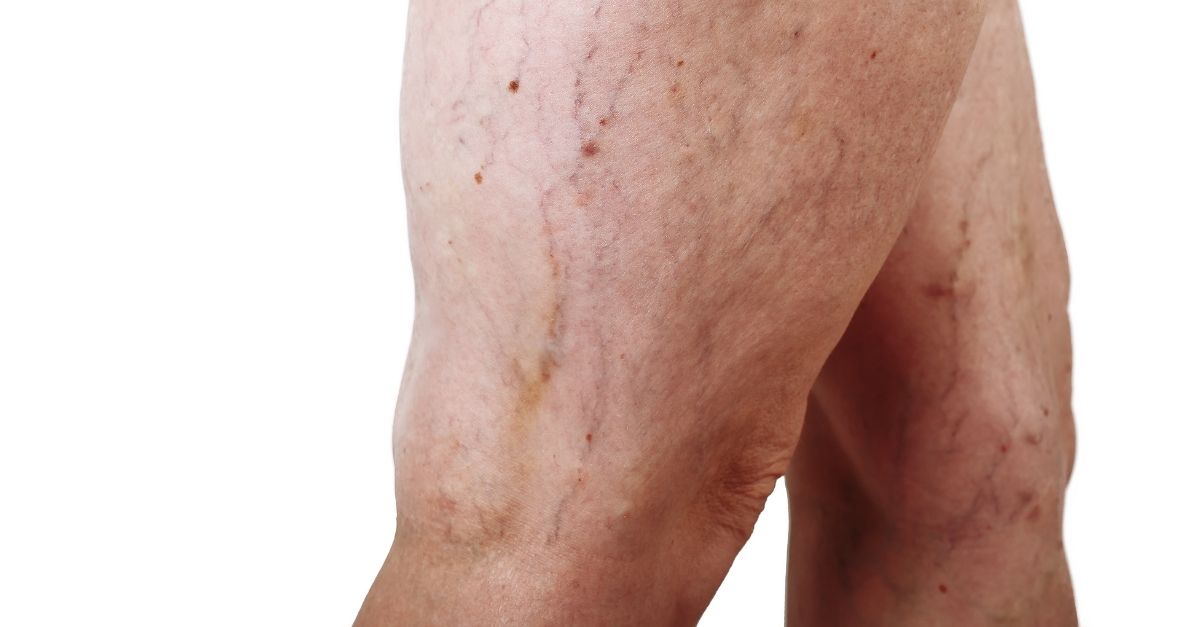 Varizes podem causar manchas na pele?