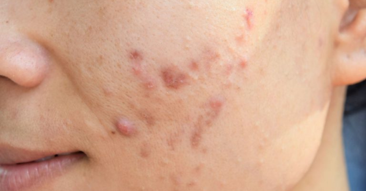 Acne adulta: causas, tratamentos e prevenção