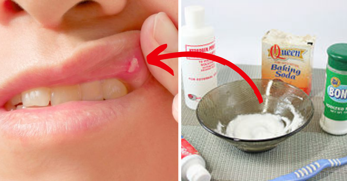 Como curar afta e por que ela aparece?