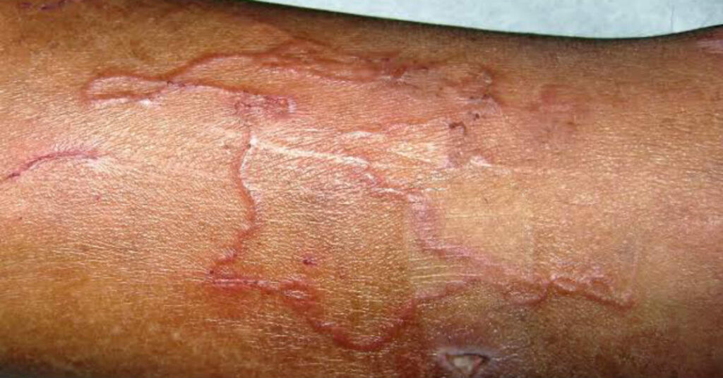 Bicho geográfico: conheça sintomas e tratamentos da larva migrans