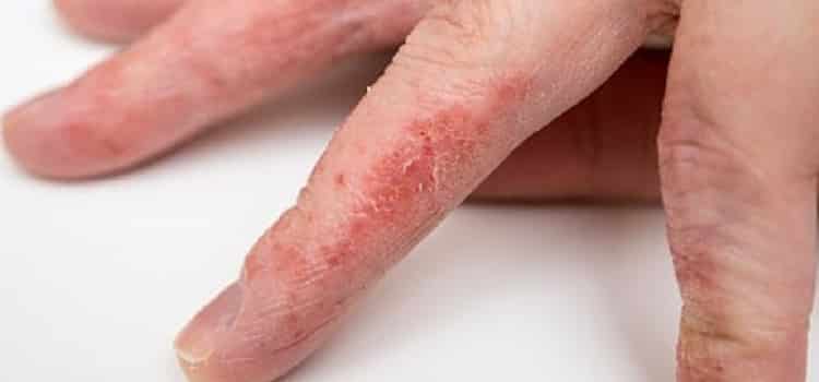 Você pode estar sofrendo de disidrose