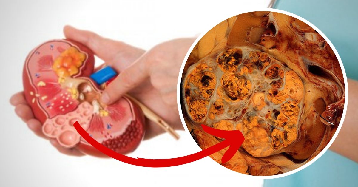 Câncer nos rins: sintomas, causas, tratamento e prevenção