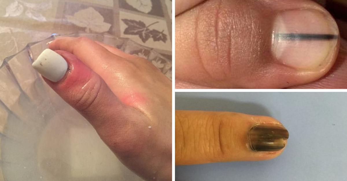 Câncer de unha: sintomas e como tratar