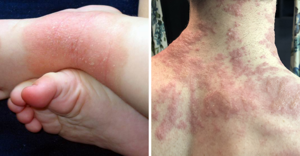 Já ouviu falar em candidíase cutânea? Saiba como prevenir.