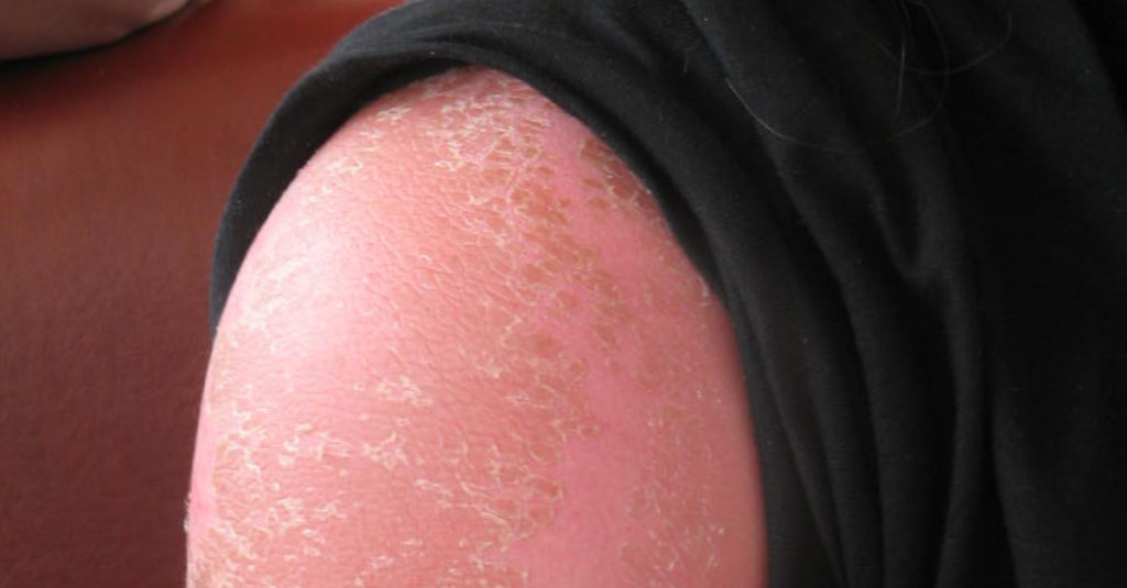 Pele descascando: causas e o que fazer