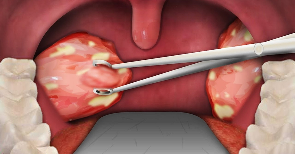 Retirar amígdalas aumenta o risco de doenças respiratórias