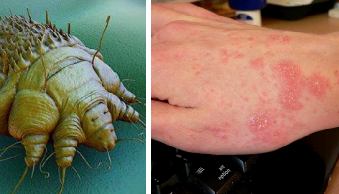 Escabiose: sintomas, o que é e qual o tratamento para a sarna