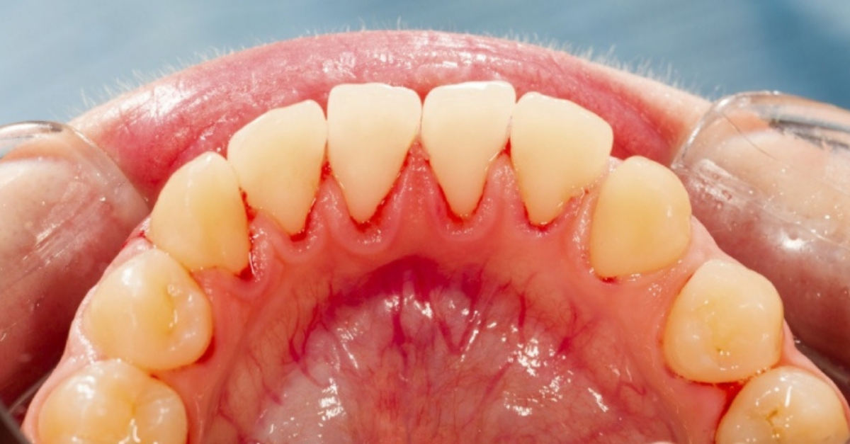 7 Problemas bucais que a diabetes causa
