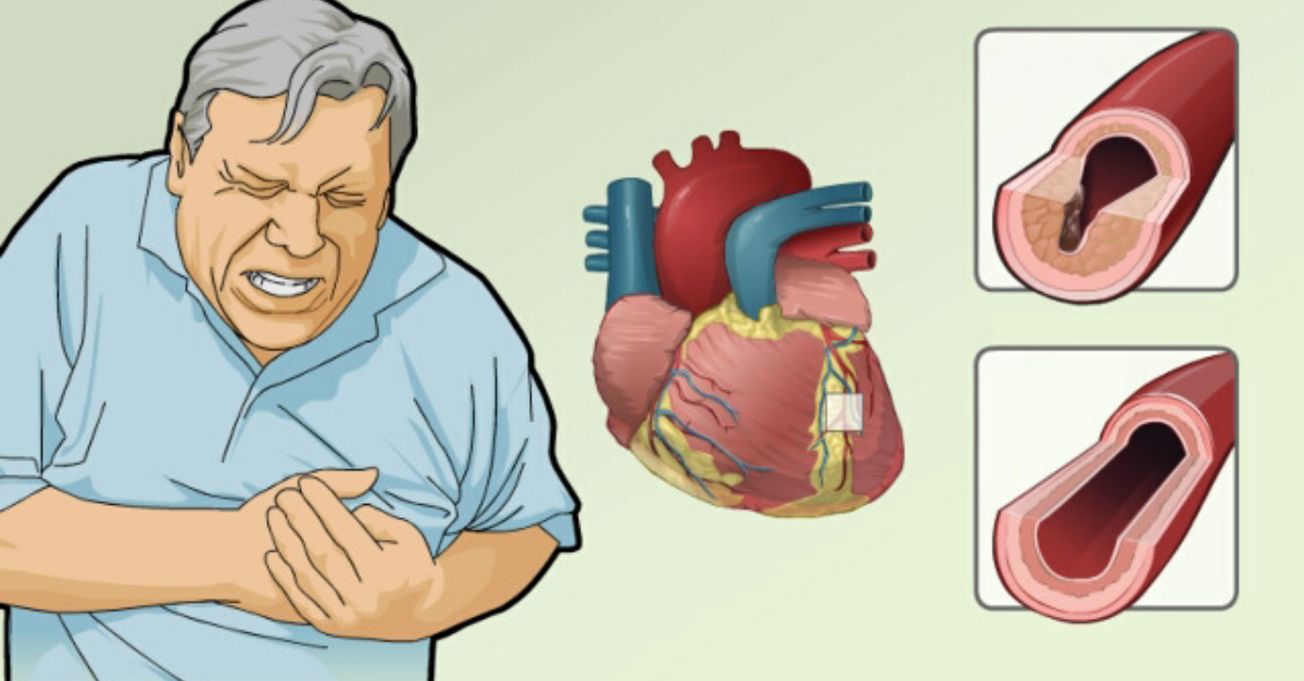 O que é angina? Conheça os sintomas e tratamentos disponíveis