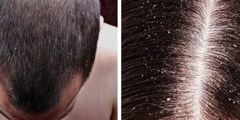 Como acabar com a caspa de vez