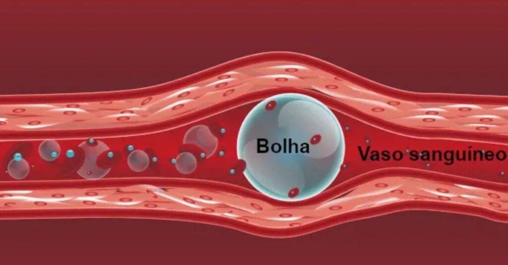 Você conhece o perigo de sofrer uma embolia gasosa?
