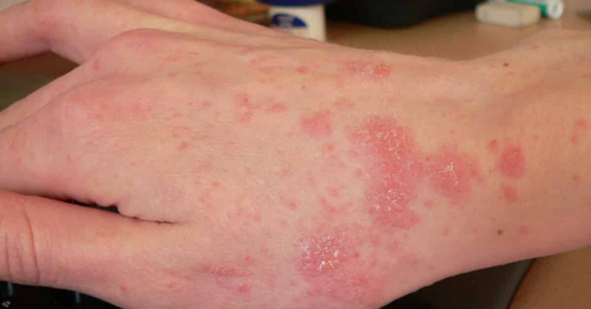 Escabiose: focos de contágio e tratamentos