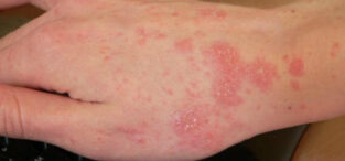 Escabiose: sintomas, o que é e qual o tratamento para a sarna