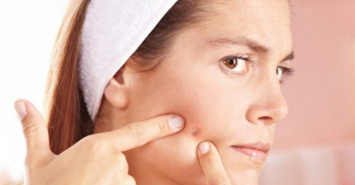 Espinha inflamada: o que é, como tratar e prevenir