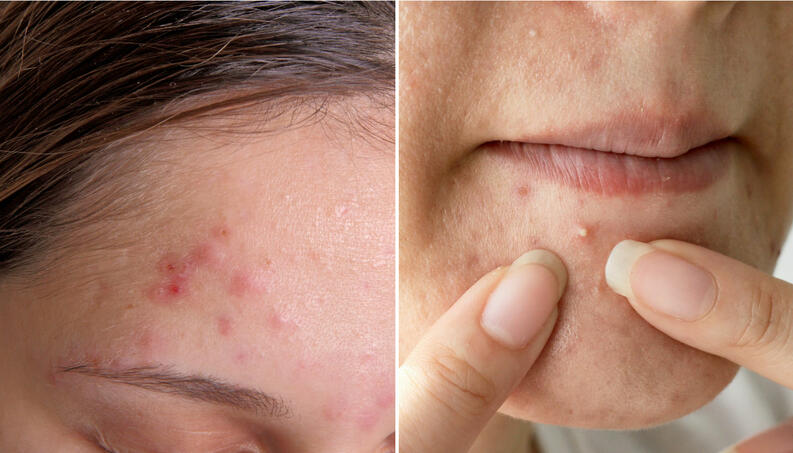 Mapa da acne: veja o que a localização da espinha indica sobre ela