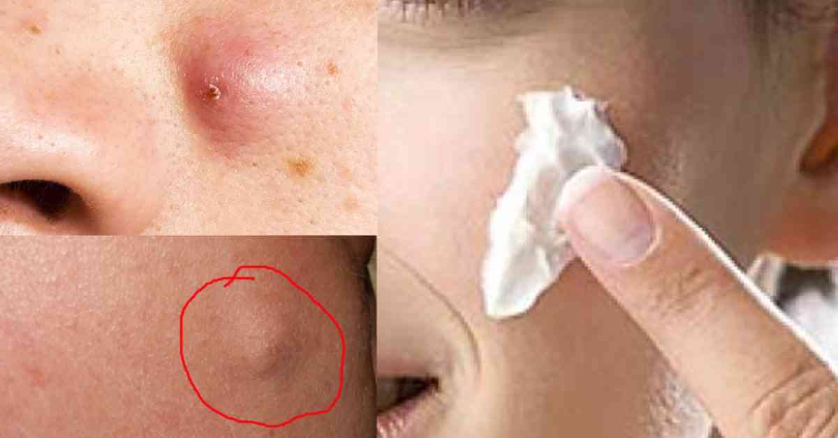 Como se livrar de uma espinha interna - dicas da dermatologista