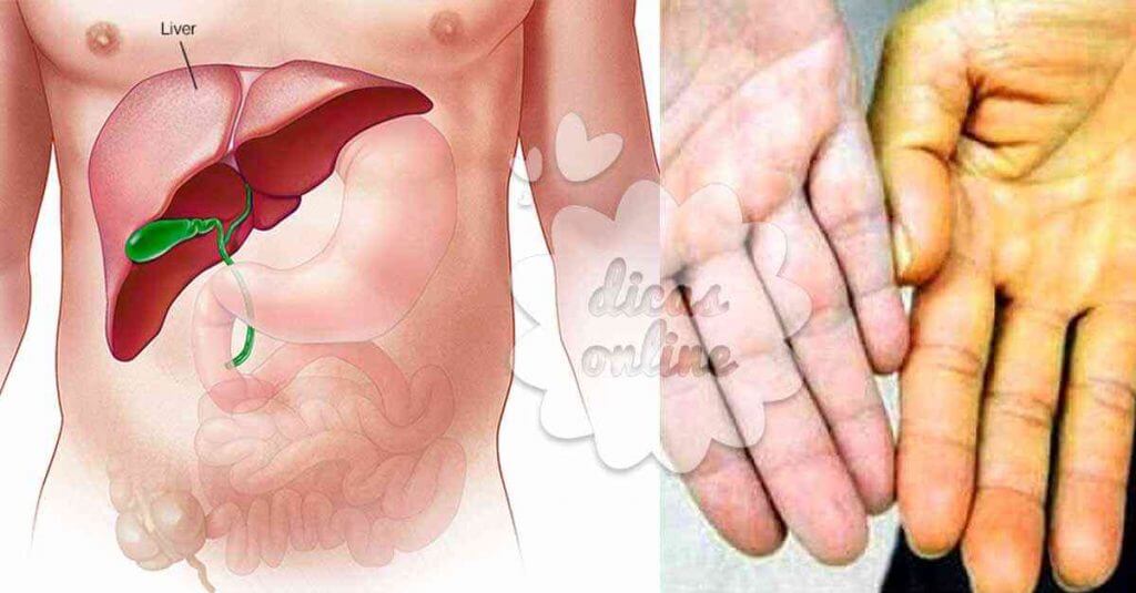 Saiba que um Fígado doente envia sinais ao corpo. Perceba aqui quais são!