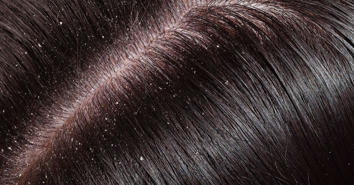 Caspa falsa: saiba o que é e como resolver