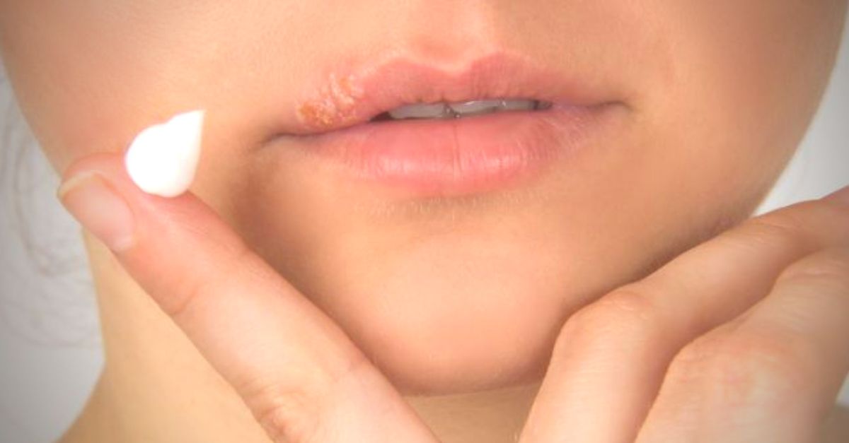 Herpes labial está relacionada à queda de imunidade