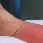 Quais sãos os sintomas de infarto mais comuns?