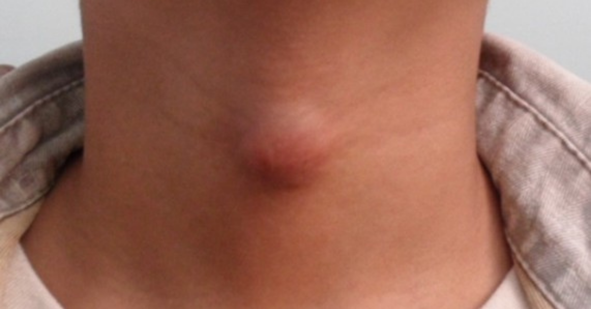 Conheça a diferença entre íngua benigna e maligna