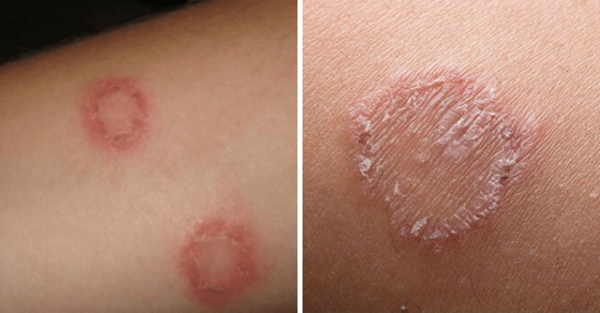 O que é, sintomas e tratamento da impingem