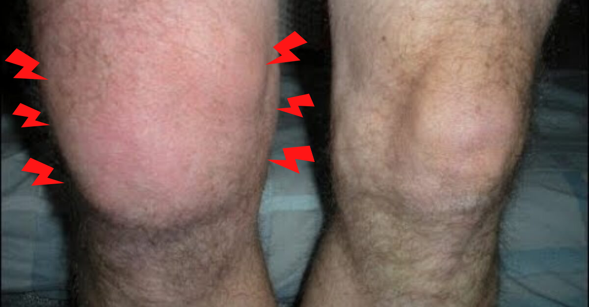 Joelho inchado: o que pode ser e como tratar?