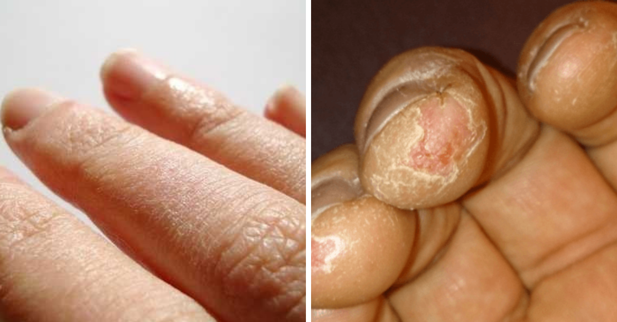 Como tratar mãos secas: 7 dicas