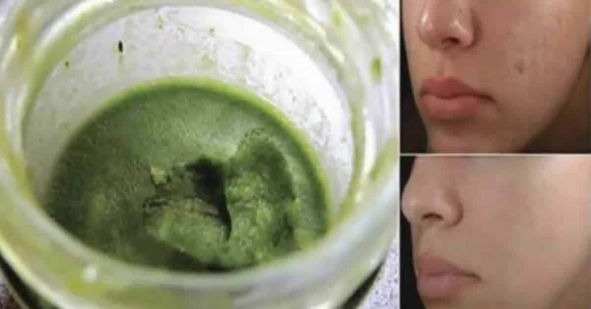 Máscara Para Tratar Acne E Cicatrizes