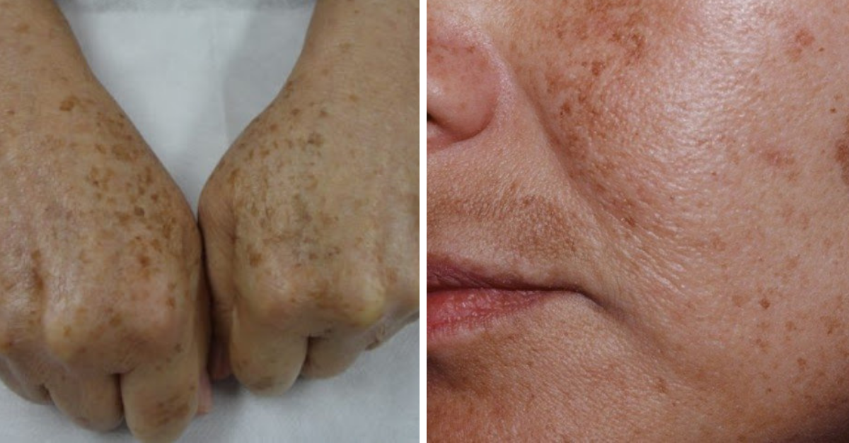 Melanose solar: saiba o que é, como prevenir e como tratar