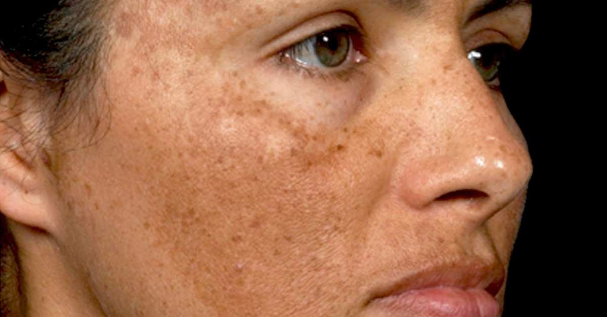 Melasma: o que é e como tratar