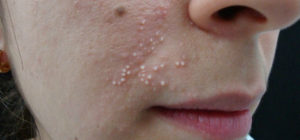 Milium: o que é, quais os tipos e causas desse problema de pele