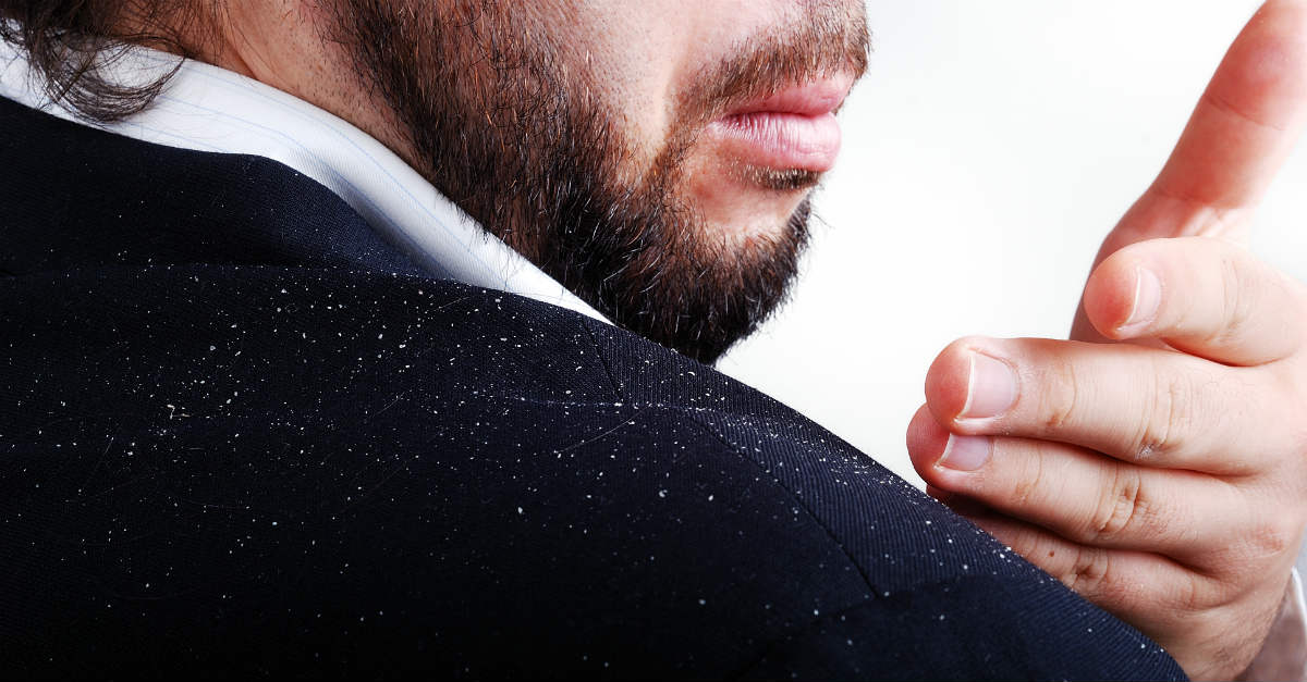 10 Mitos e verdades sobre a caspa que você não sabia!