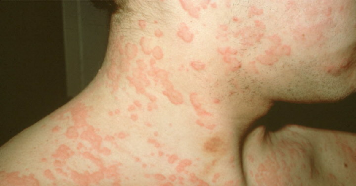 Mononucleose: o que é, sintomas e tratamento