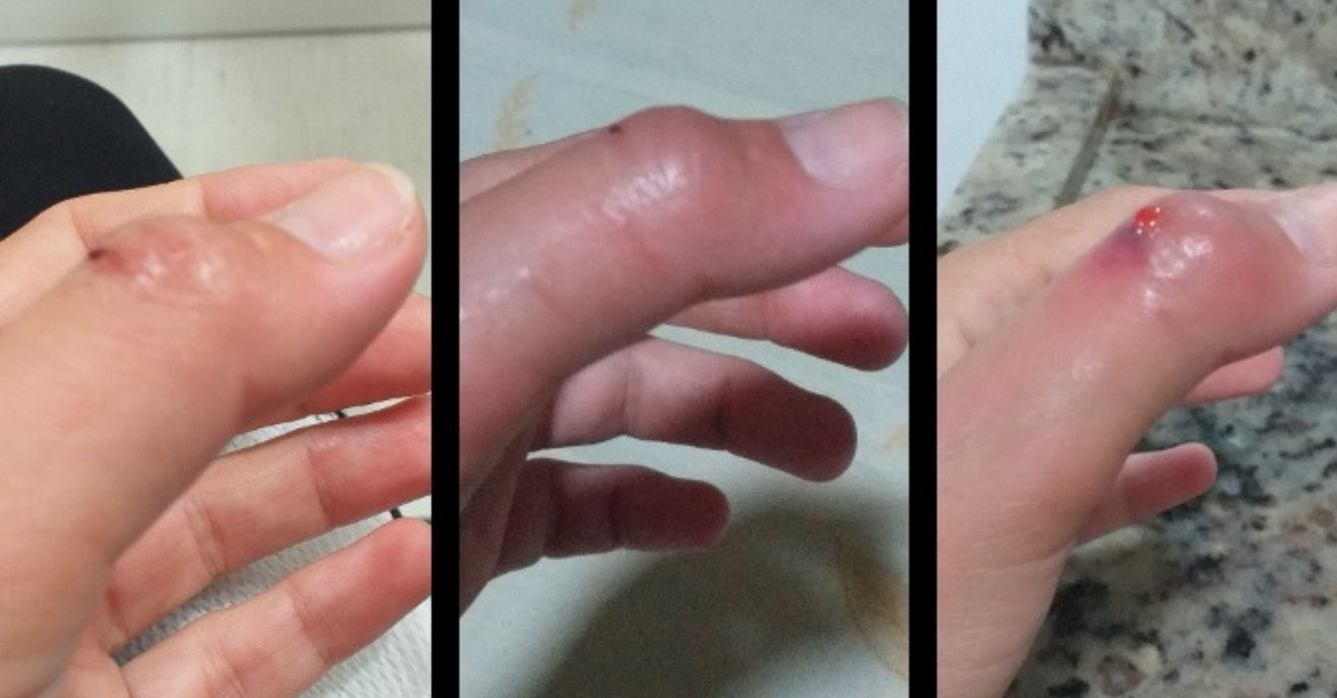 O que fazer em caso de mordida de gato ou cachorro