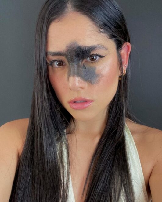 Representatividade para quem tem nevo melanocítico congênito