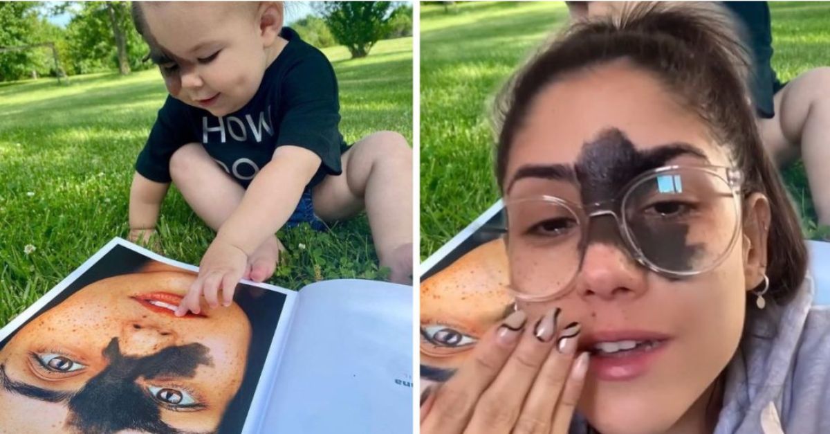 Representatividade para quem tem nevo melanocítico congênito