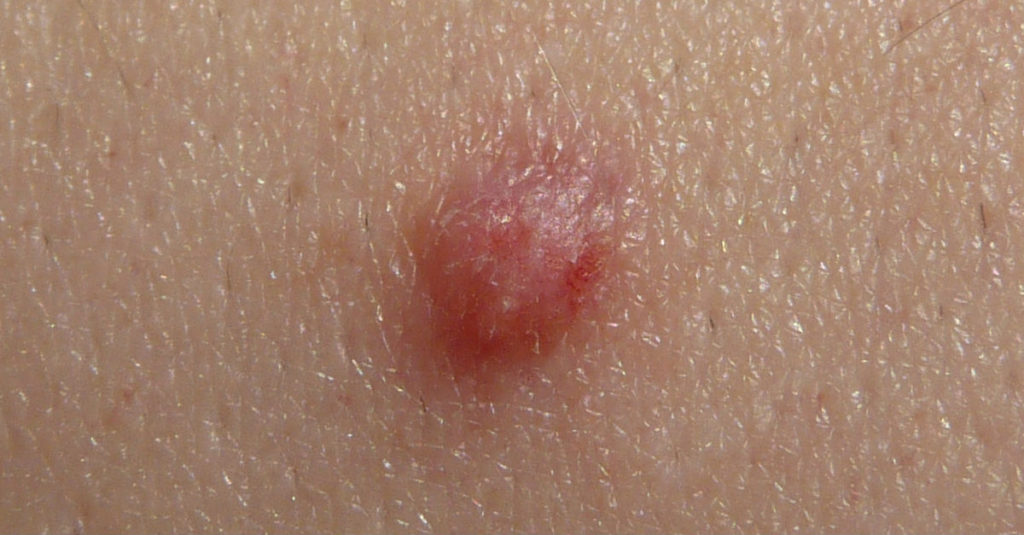 O que causa verrugas?