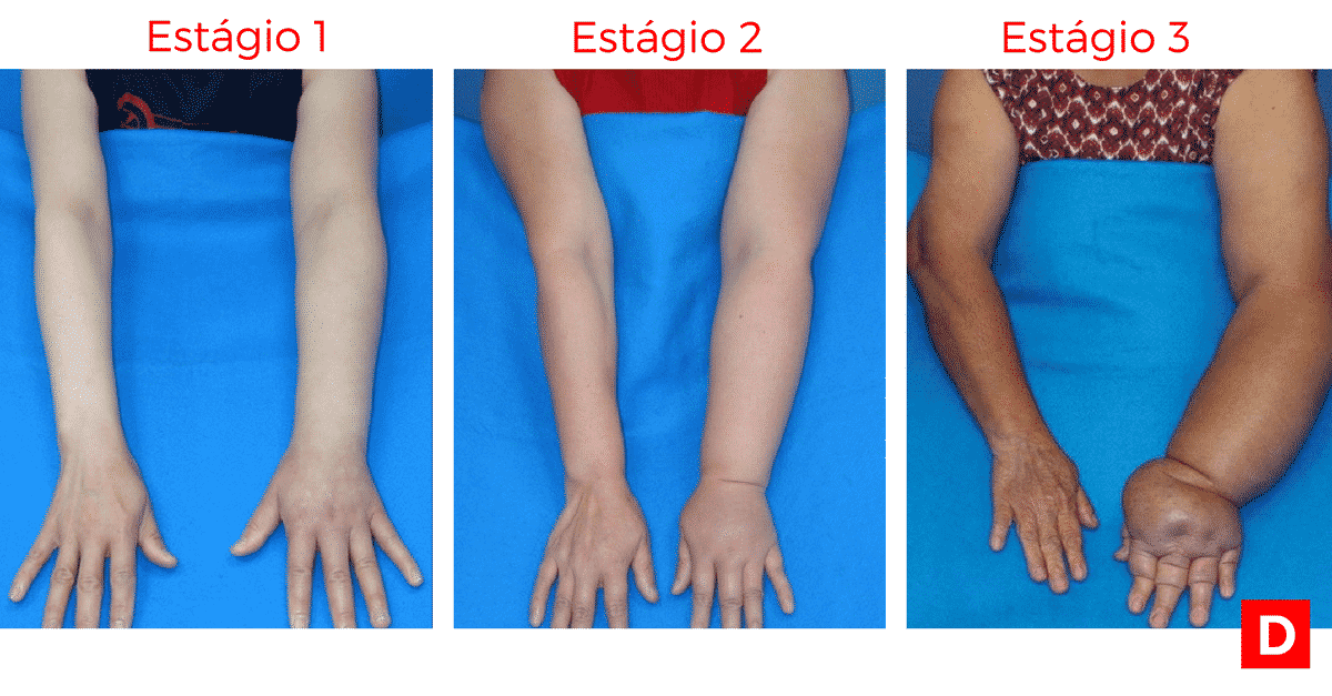 Linfedema: saiba o que é e como tratar esse problema vascular