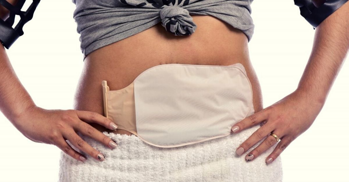 O Que Significa Ostomias - NAZAEDU