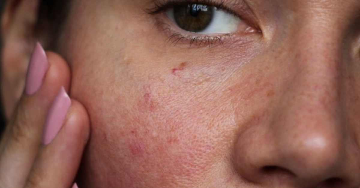 3 Receitas caseiras fáceis para hidratar a pele seca