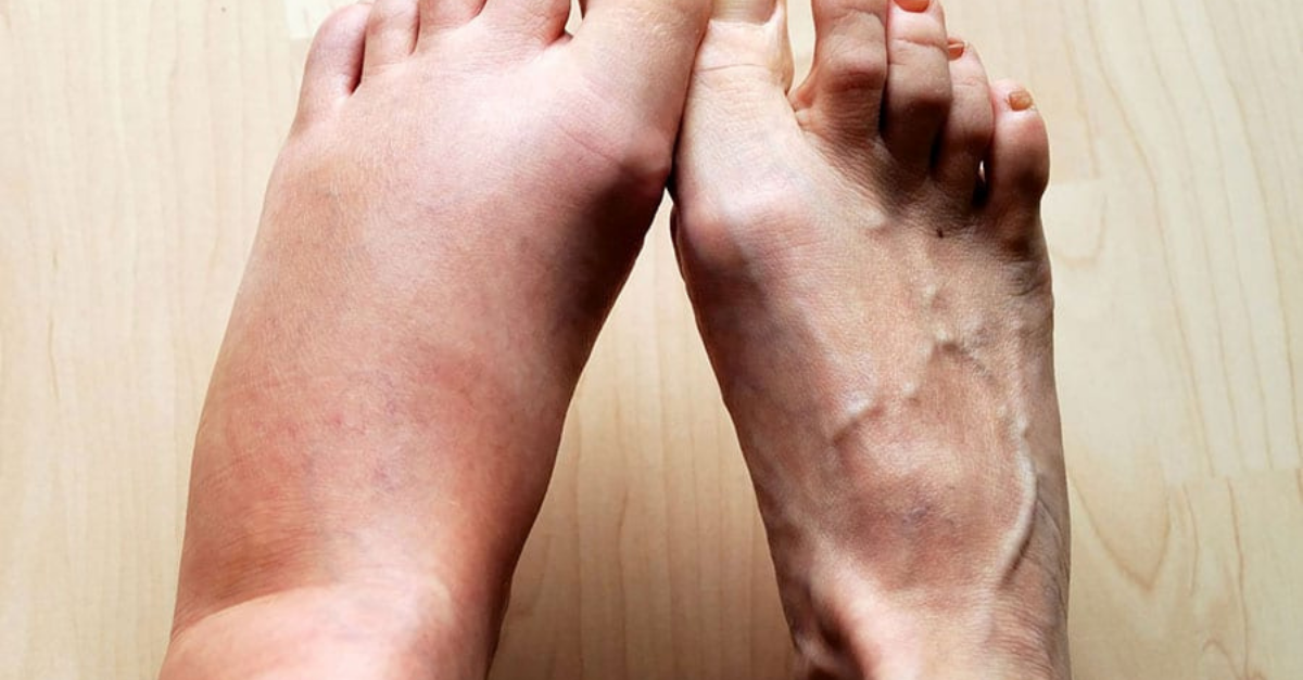 4 Dicas e ações para diminuir o inchaço no corpo